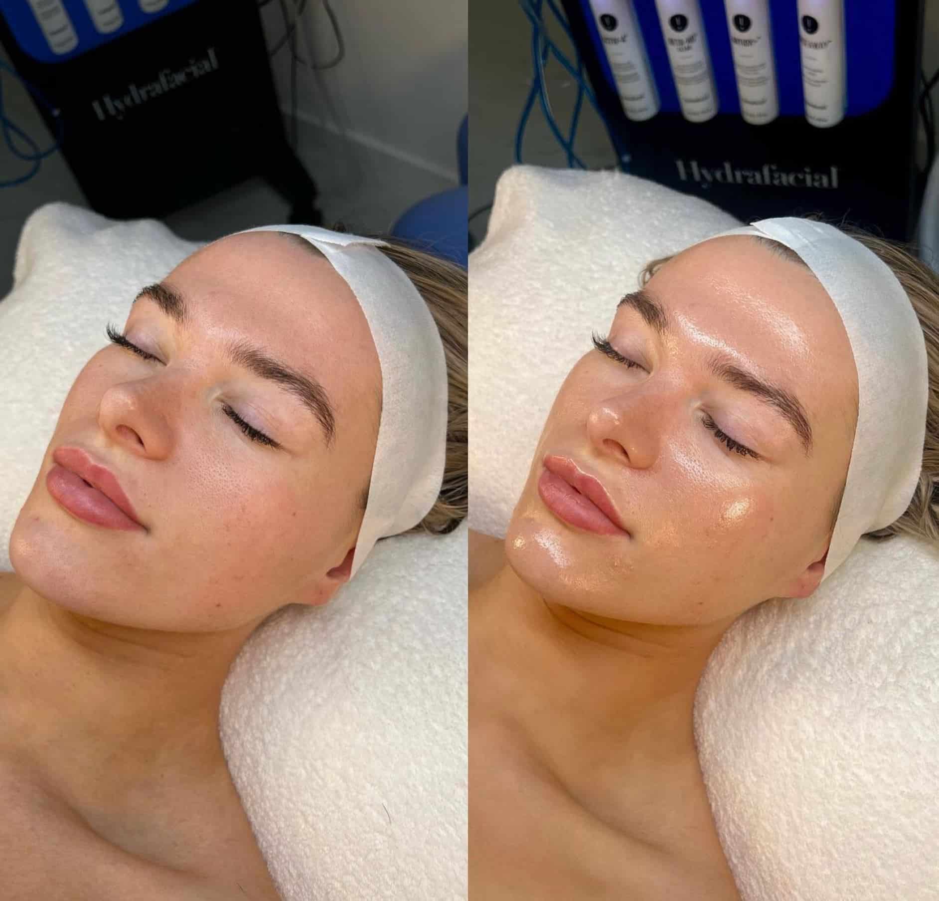 Get Radiant, Hydrated Skin with a Revitalizing HydraFacial